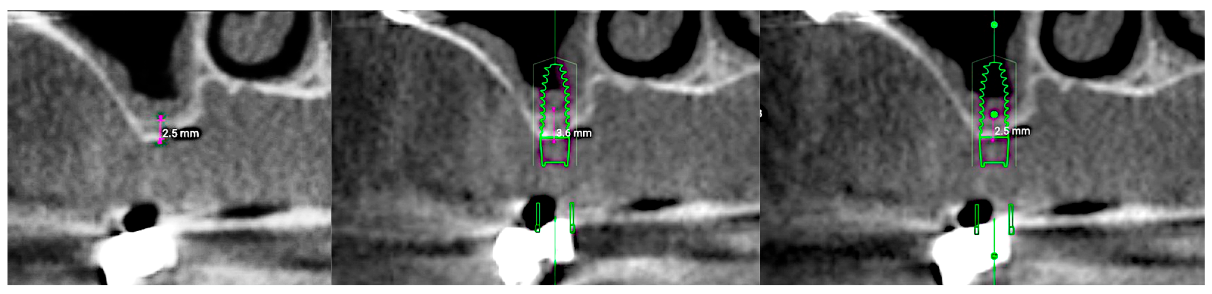 Safe Crestal Sinus Elevation Below 3 mm Residual Bone with Tissue-Level ...