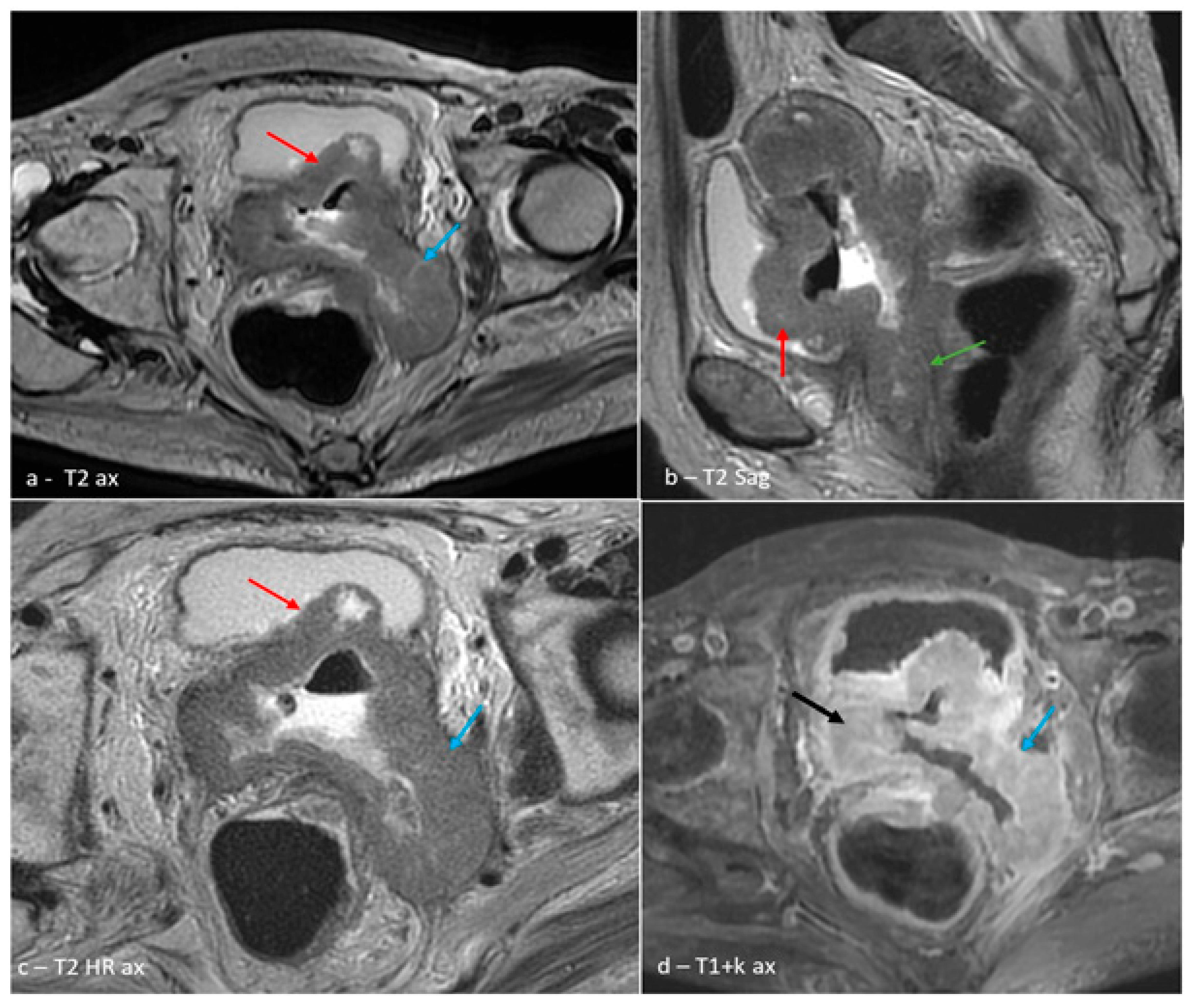 Clinically Advanced Warty Invasive Squamous Cell Carcinoma of the ...