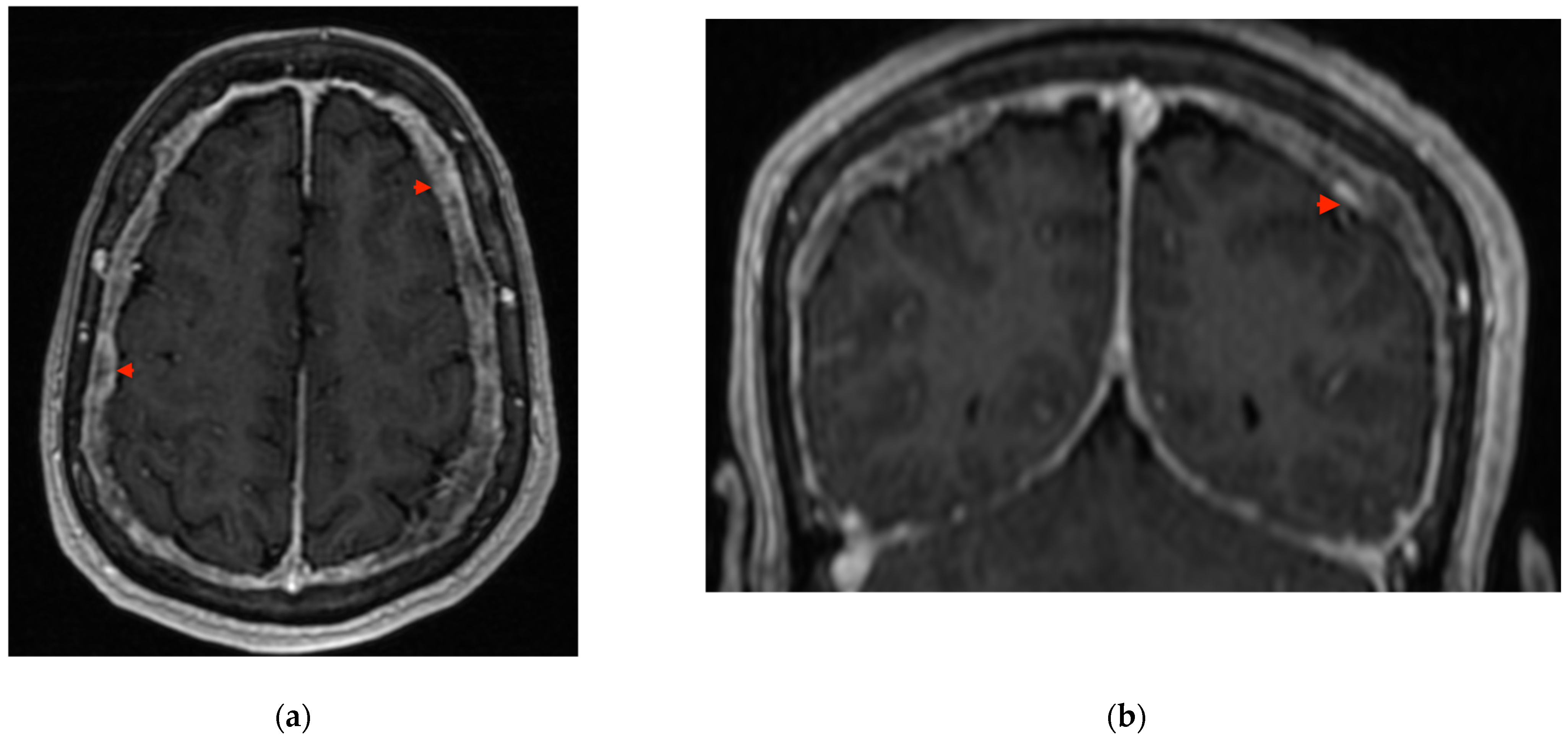 Idiopathic Hypertrophic Pachymeningitis with Elevated Anti ...