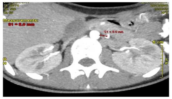 Persistent Vomiting and Epigastric Pain in an Adolescent: A Case of ...