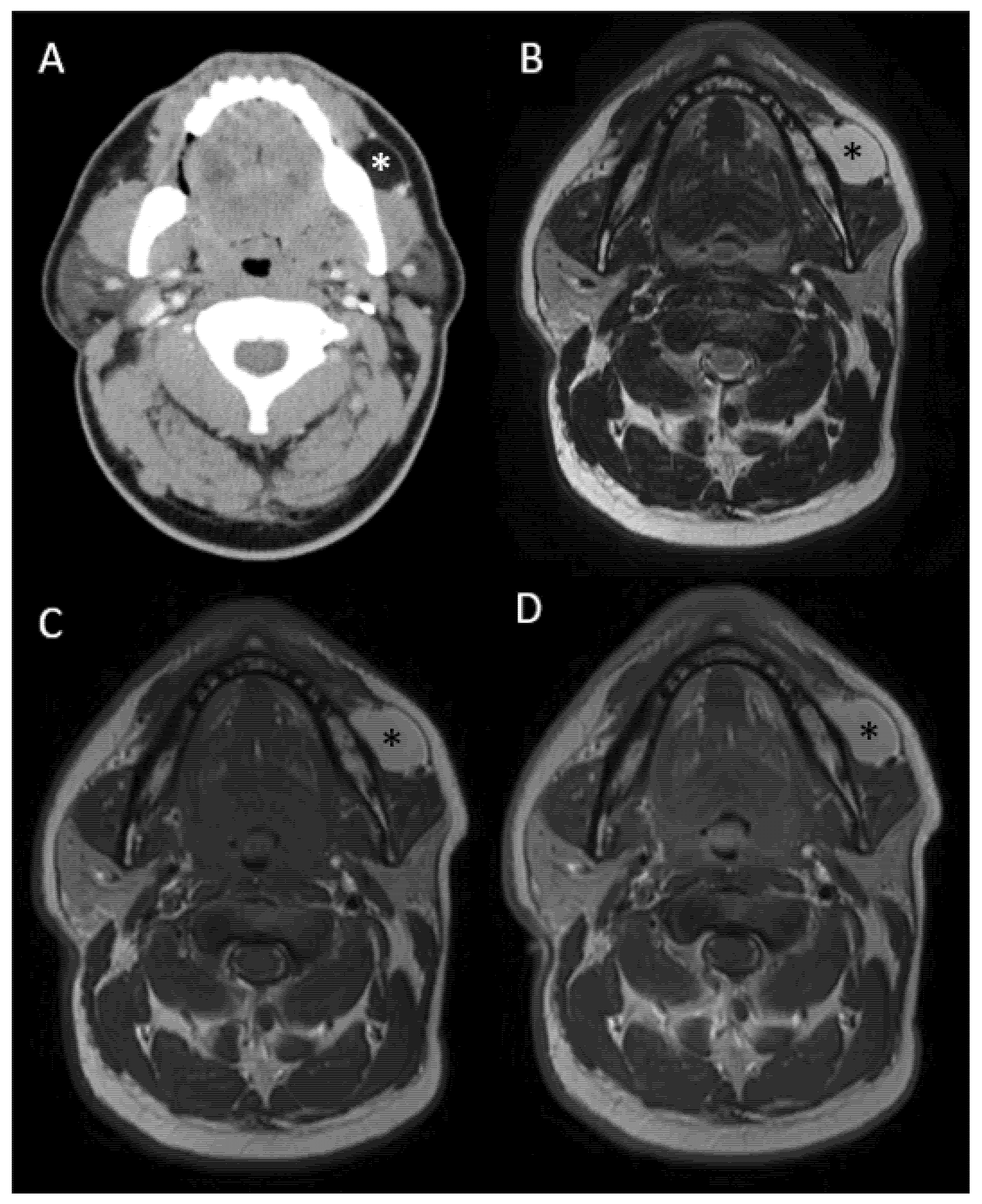 Fibrolipoma of the Buccal Space in a 47-Year-Old Male: A Case Report | MDPI
