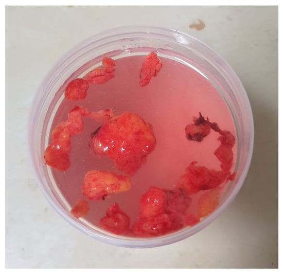 Fibrolipoma of the Buccal Space in a 47-Year-Old Male: A Case Report | MDPI