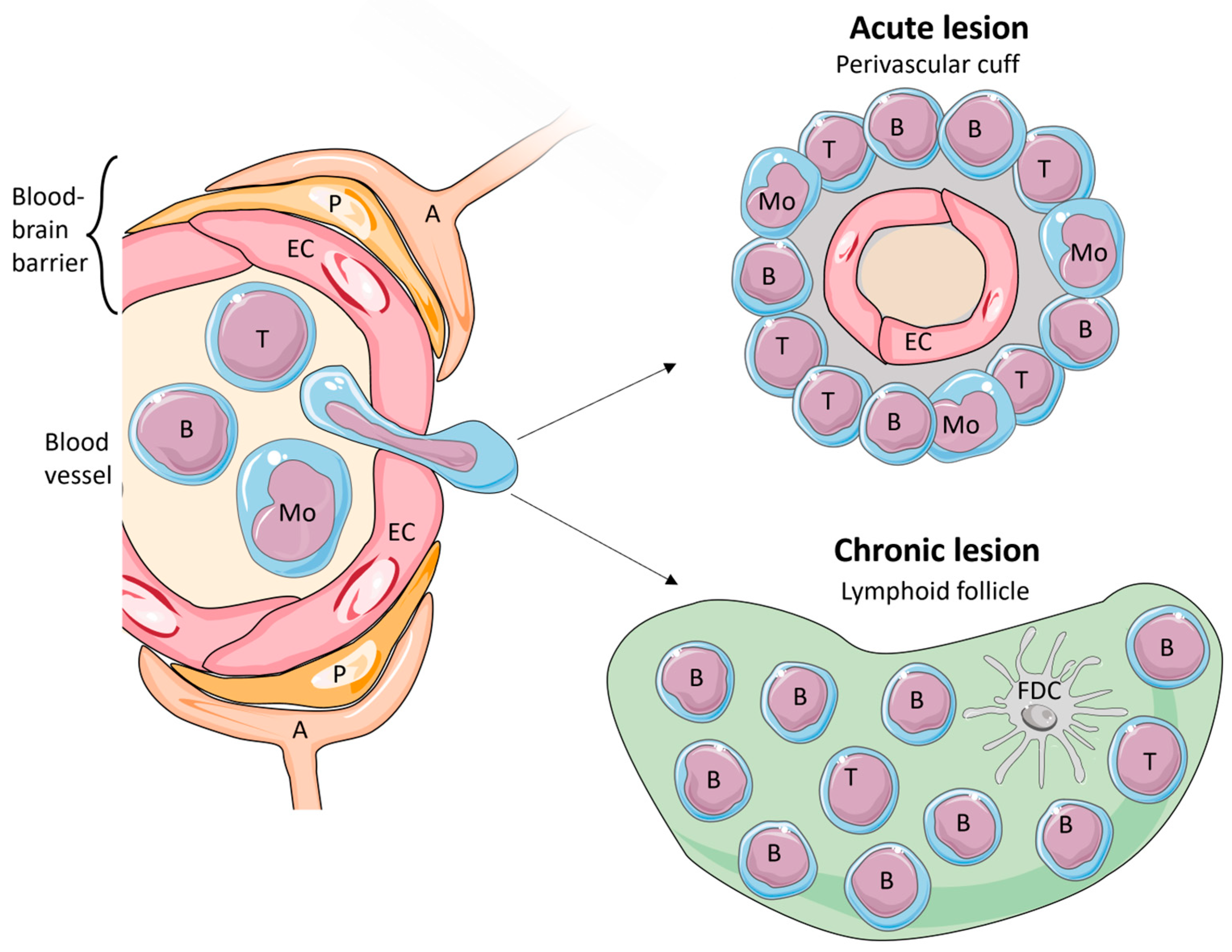 Multiple Sclerosis: Immune Cells, Histopathology, and Therapeutics | MDPI
