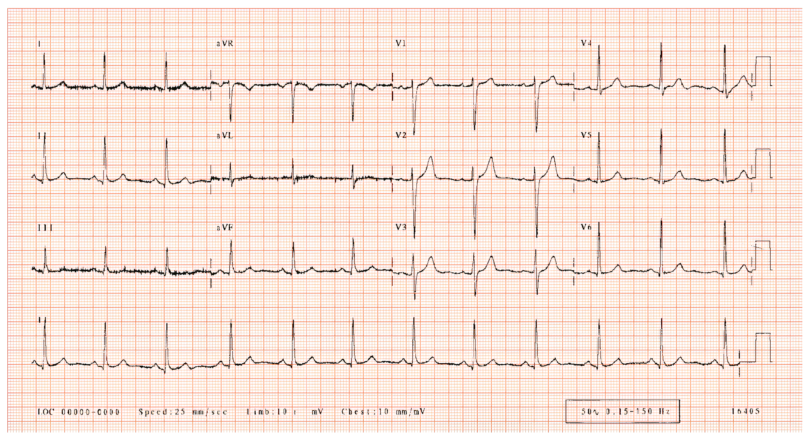 Cardiac Arrhythmia Classification Using Advanced Deep Learning Techniques on Digitized ECG ...