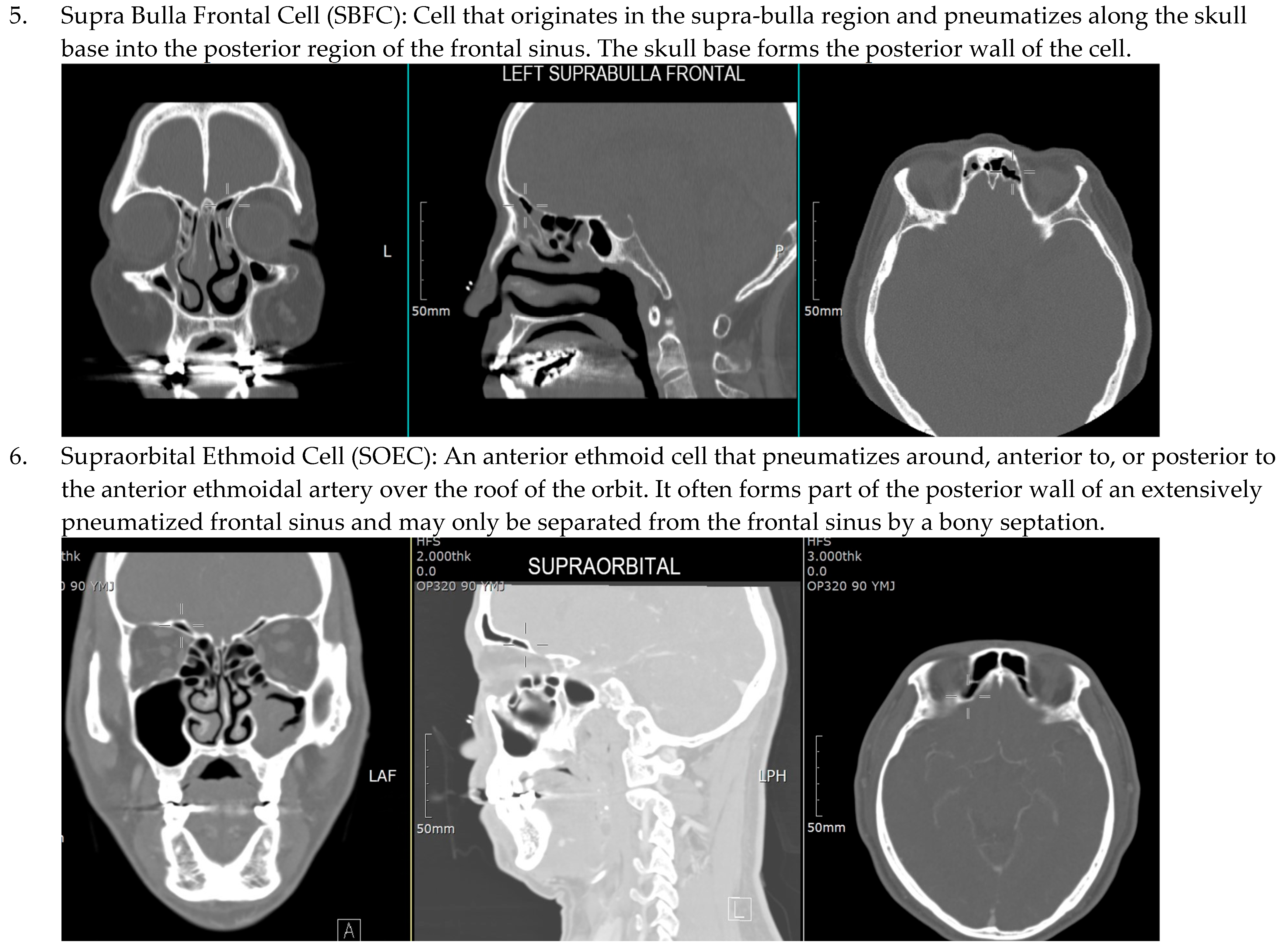 An Analysis of Frontoethmoid Cell Types According to the International ...
