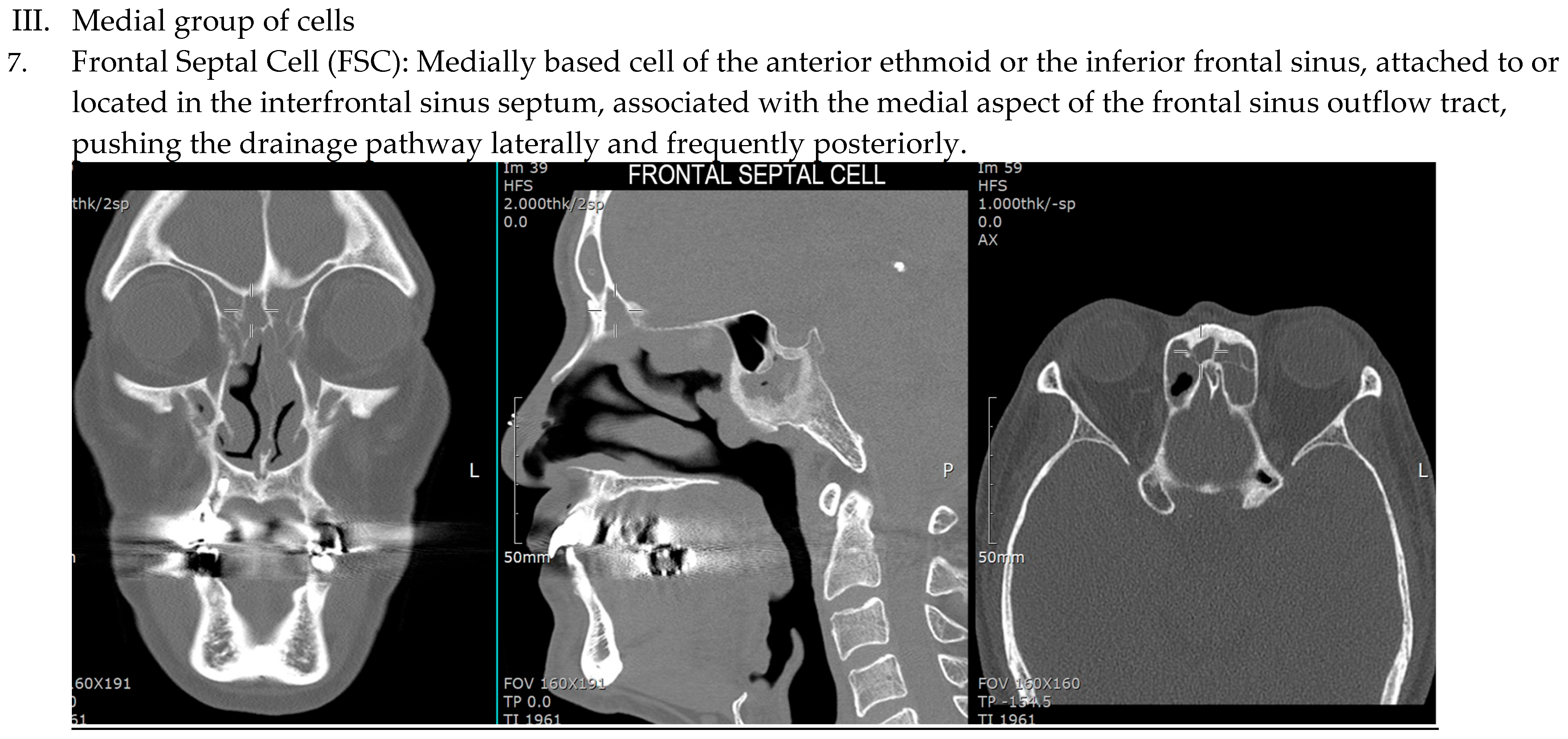 An Analysis of Frontoethmoid Cell Types According to the International ...