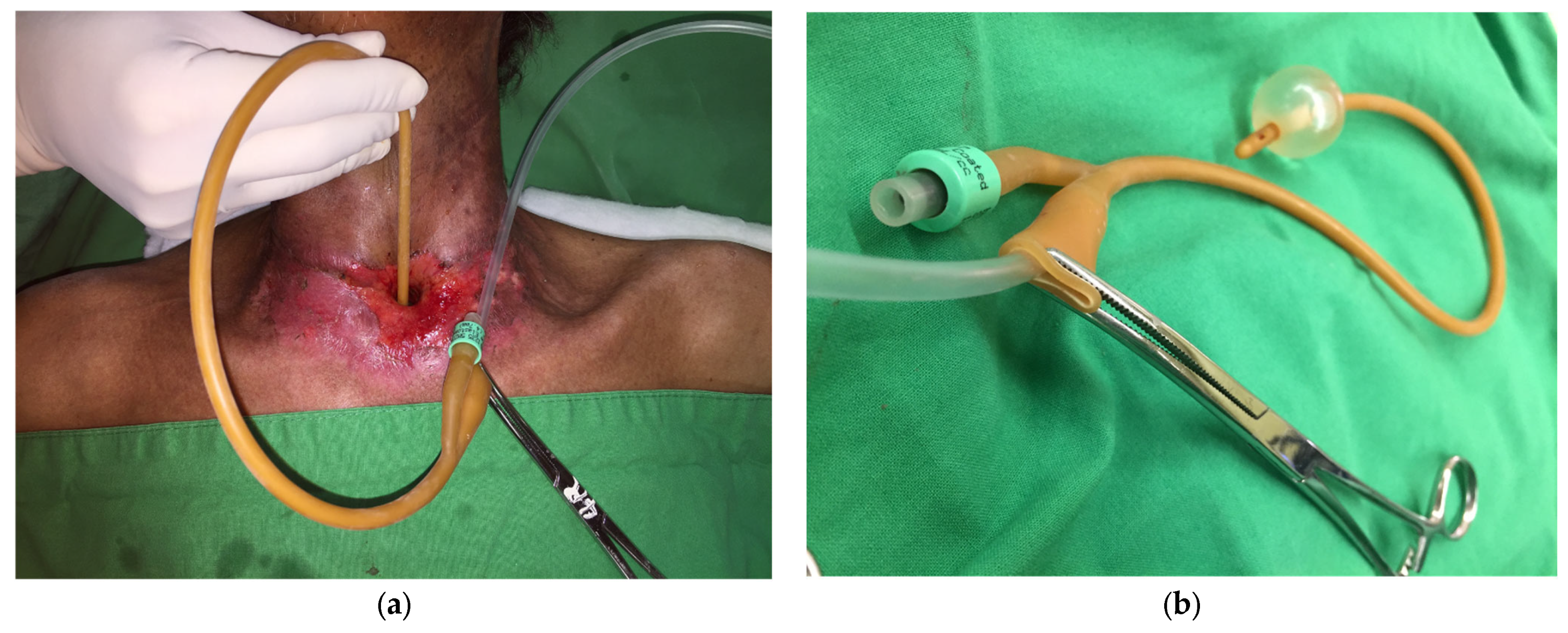 A Novel Approach to Tracheostomal and Tracheal Stenosis: Dilatation ...
