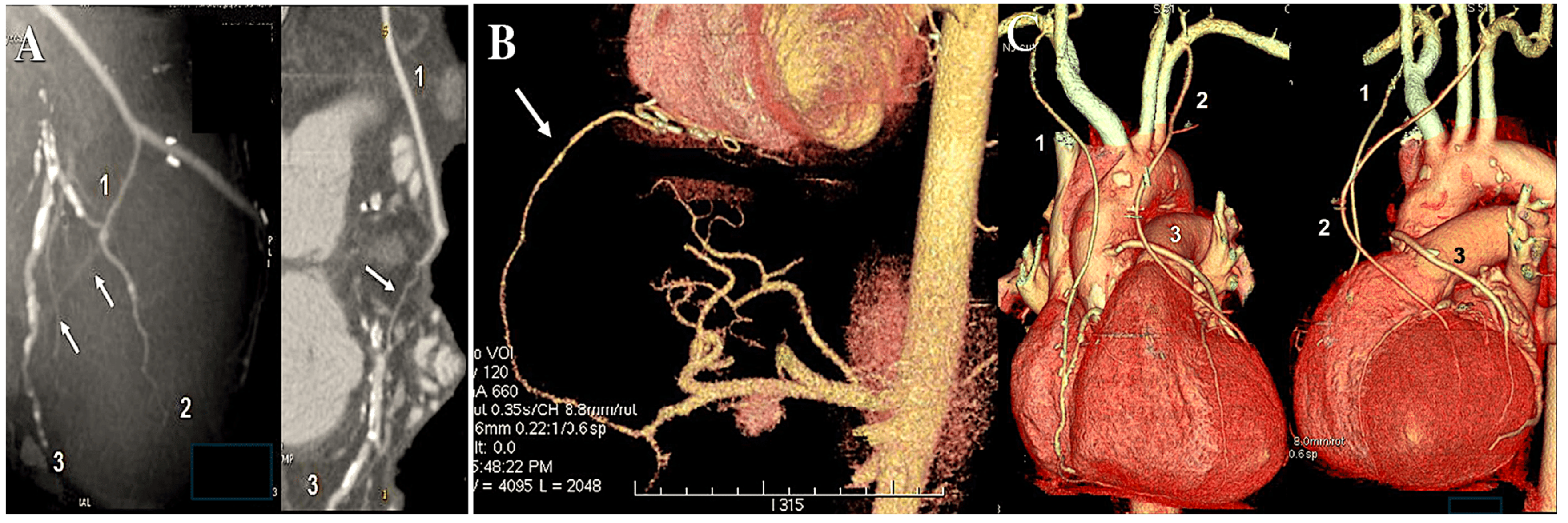 Radial Artery Used as Conduit for Coronary Artery Bypass Grafting | MDPI