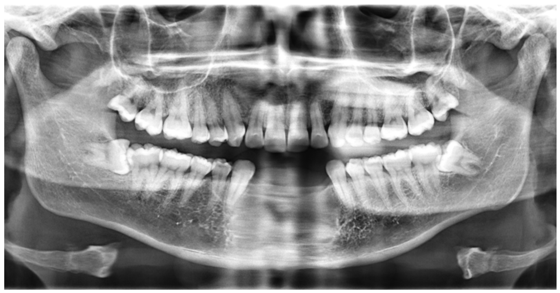 Odontogenic Myxoma in the Anterior Part of the Mandible—A Case Report ...
