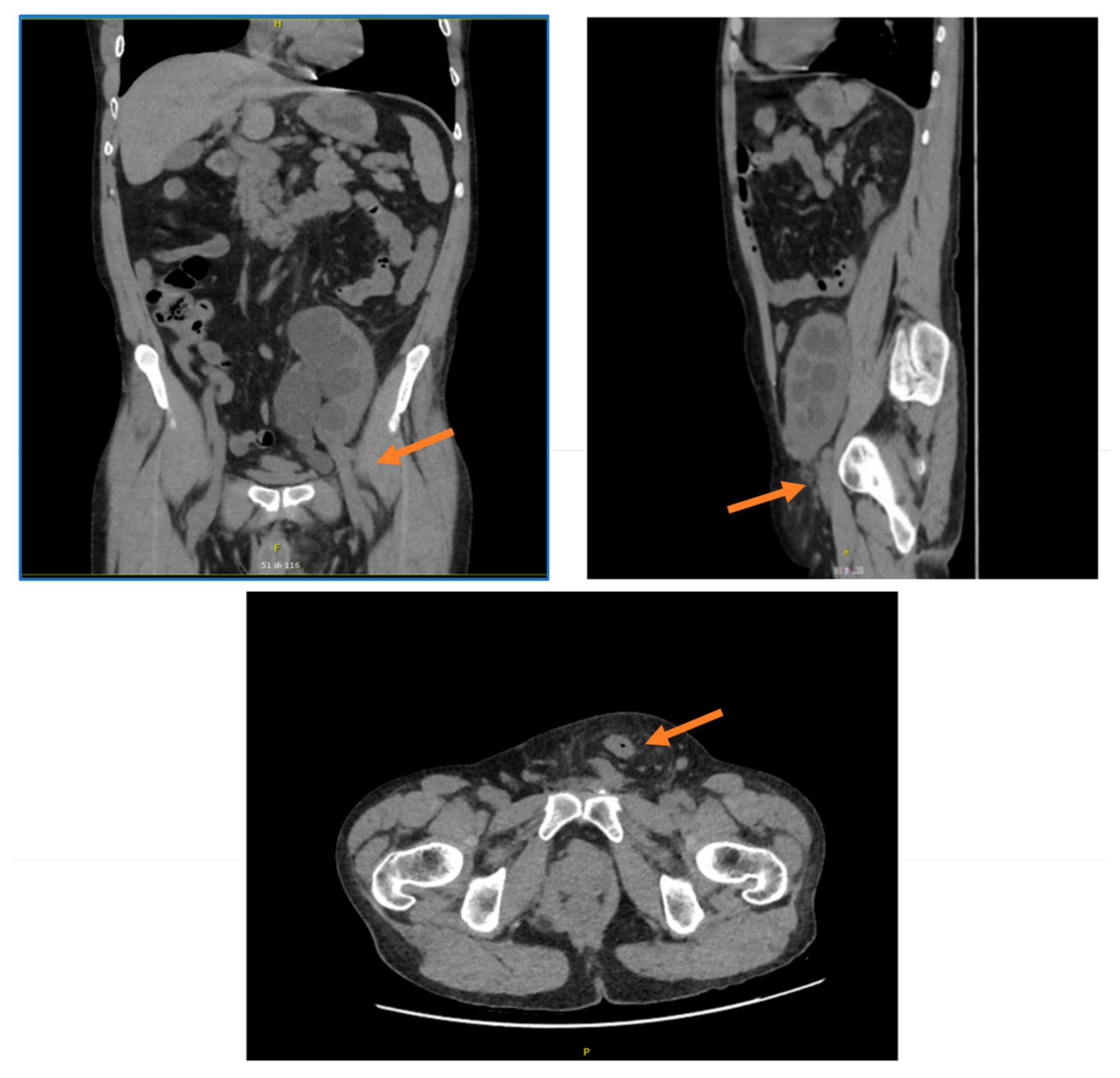 Inguinal Herniation Of The Transplanted Ureter A Systematic Review Mdpi