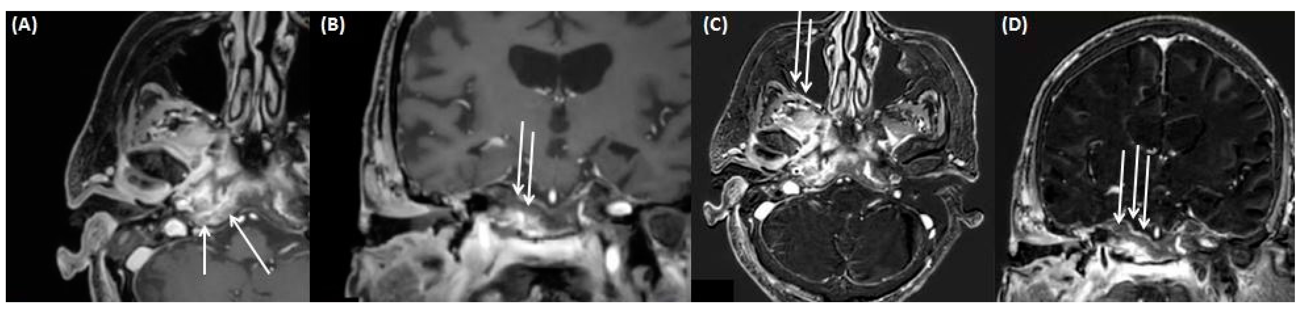 Imaging of Pathologies of the Temporal Bone and Middle Ear ...