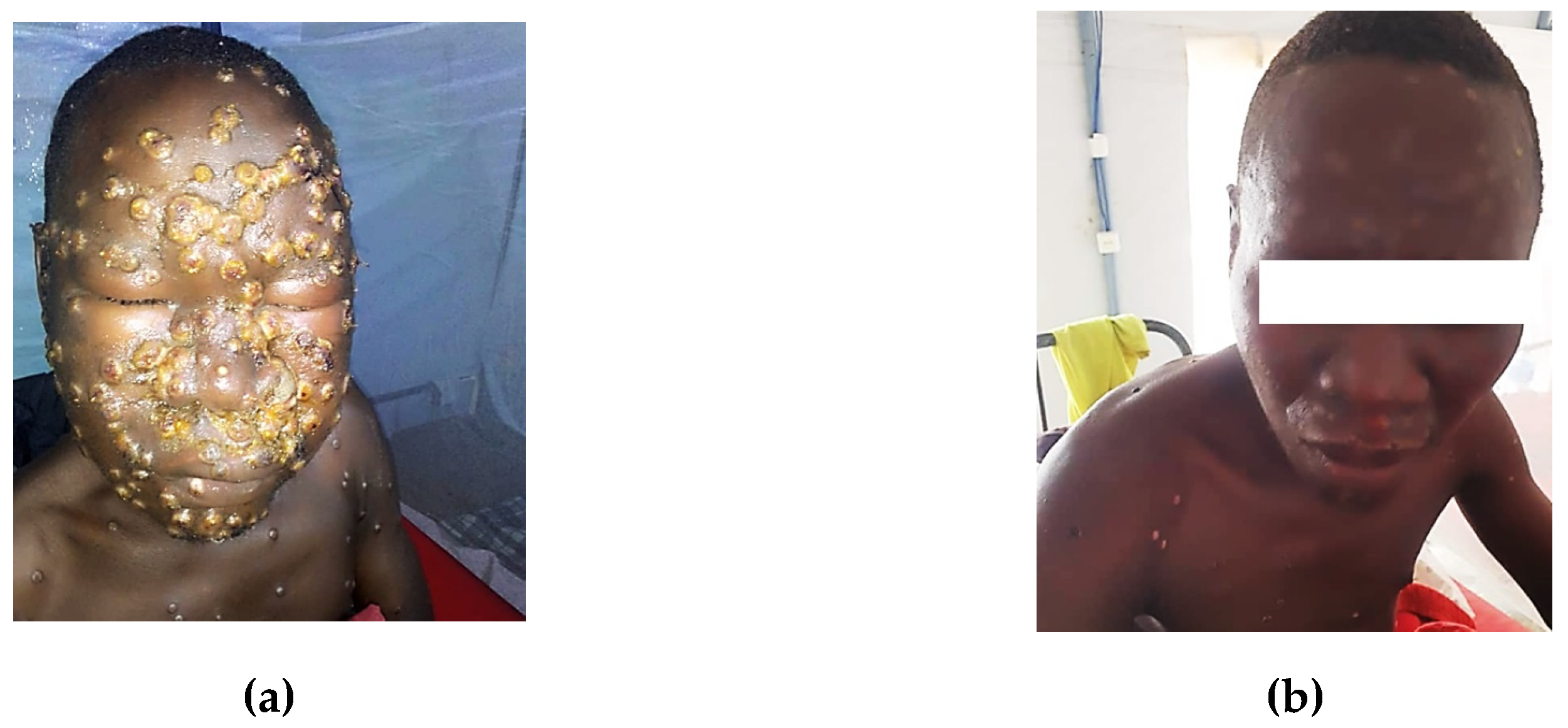 Clinical Predictors and Determinants of Mpox Complications in ...